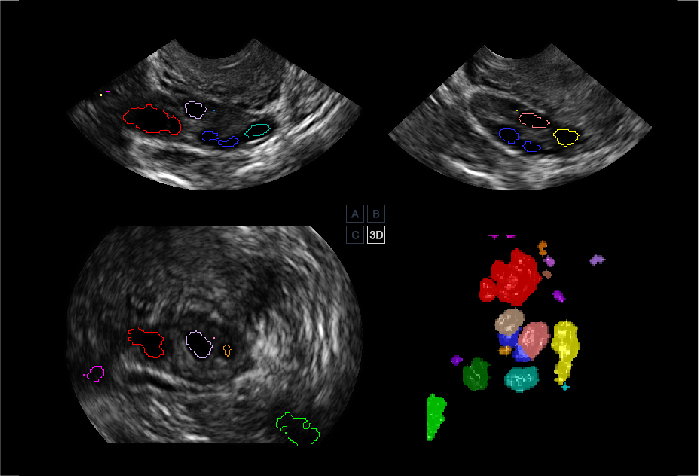 SonoScape P20 - BMS Medical Systems